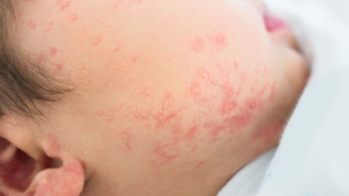 Gejala Henoch-Schonlein Purpura pada Anak - KlikDokter