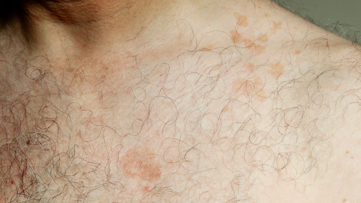 Beragam Obat yang Ampuh Mengatasi Panu - KlikDokter