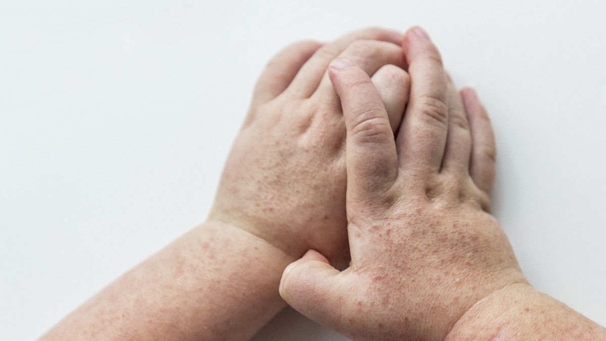 Waspada Penyakit Scarlet Fever, Ini Gejalanya! - KlikDokter