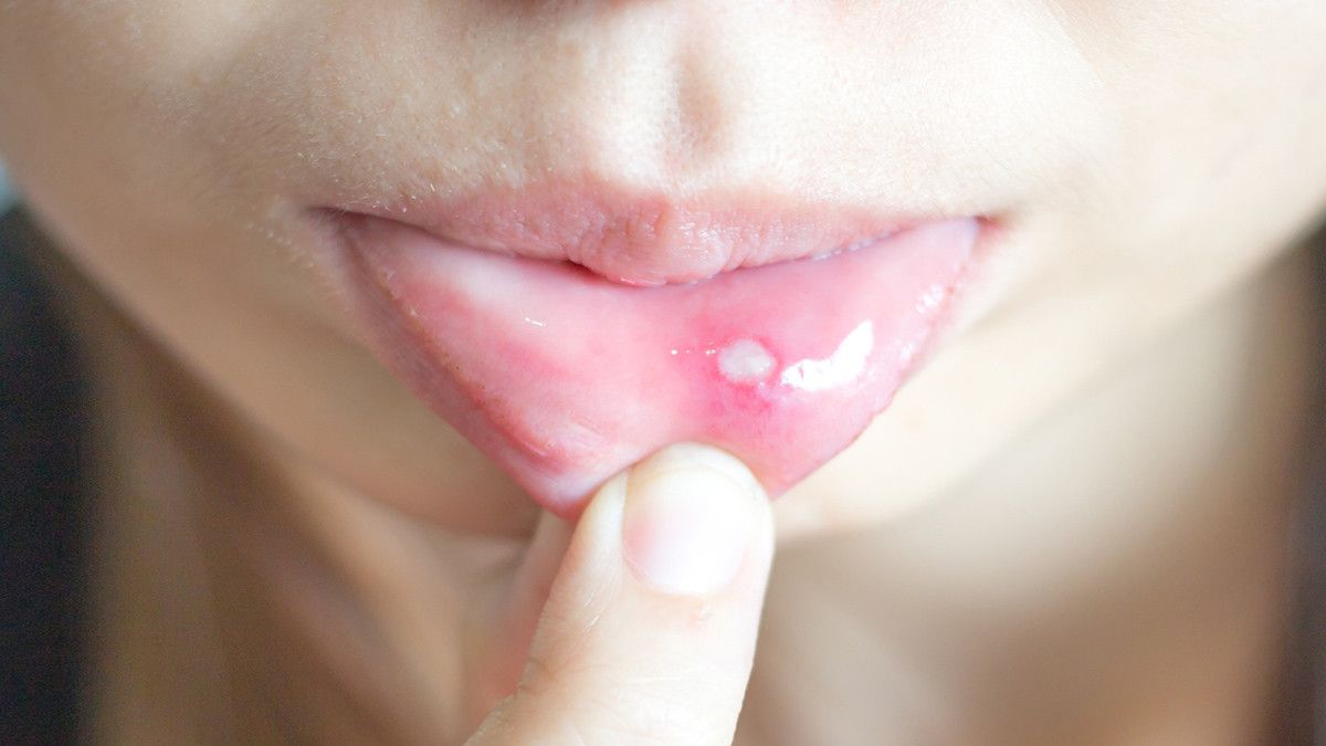 Sariawan Tak Kunjung Sembuh? Waspada Tanda Kanker Gusi - KlikDokter