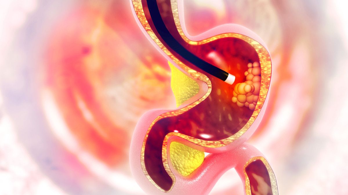 Prosedur Pemeriksaan Endoskopi yang Perlu Diketahui - KlikDokter