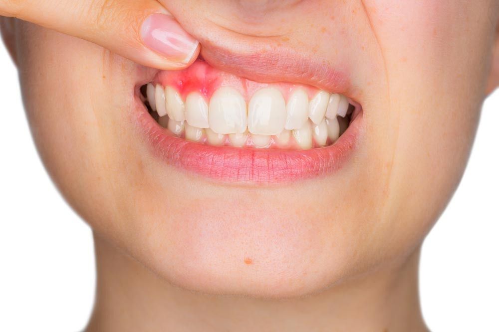 Radang Gusi (Gingivitis) - Penyebab, Gejala, Pengobatan - KlikDokter