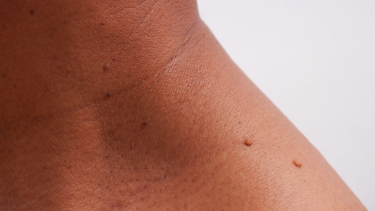 Muncul Kerutan di Leher, Waspada Neck Tag! - KlikDokter