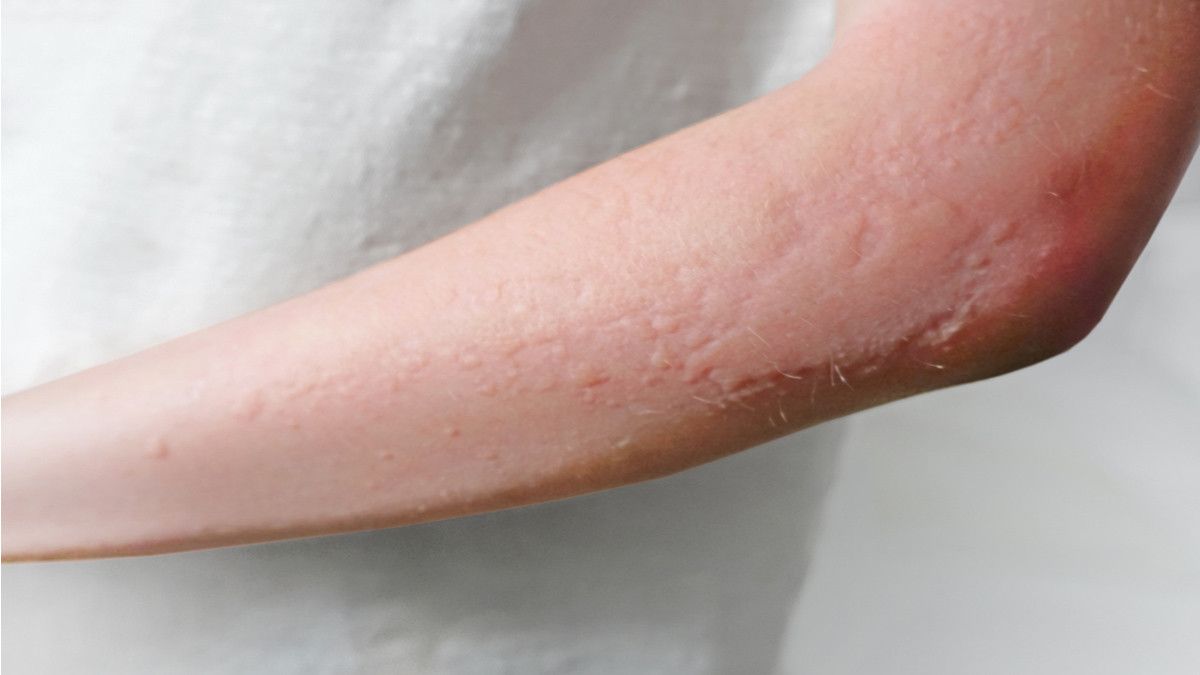 Penyebab dan Jenis-jenis Dermatitis Kontak - KlikDokter