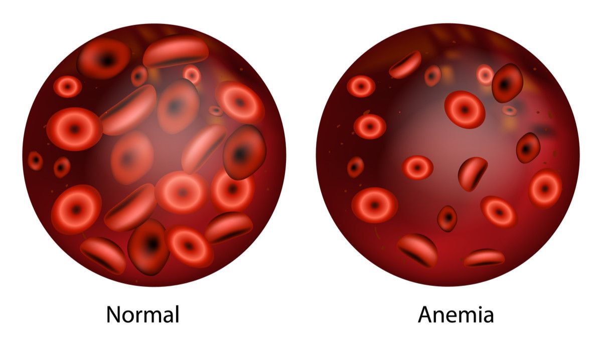 Apakah Komplikasi Anemia Bisa Menyebabkan Kematian? - KlikDokter