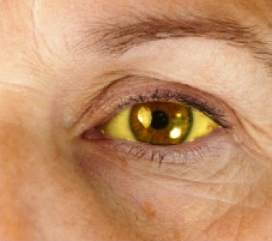 9 Penyebab Mata Kuning dan Kotor, Tanda Penyakit Apa? - KlikDokter