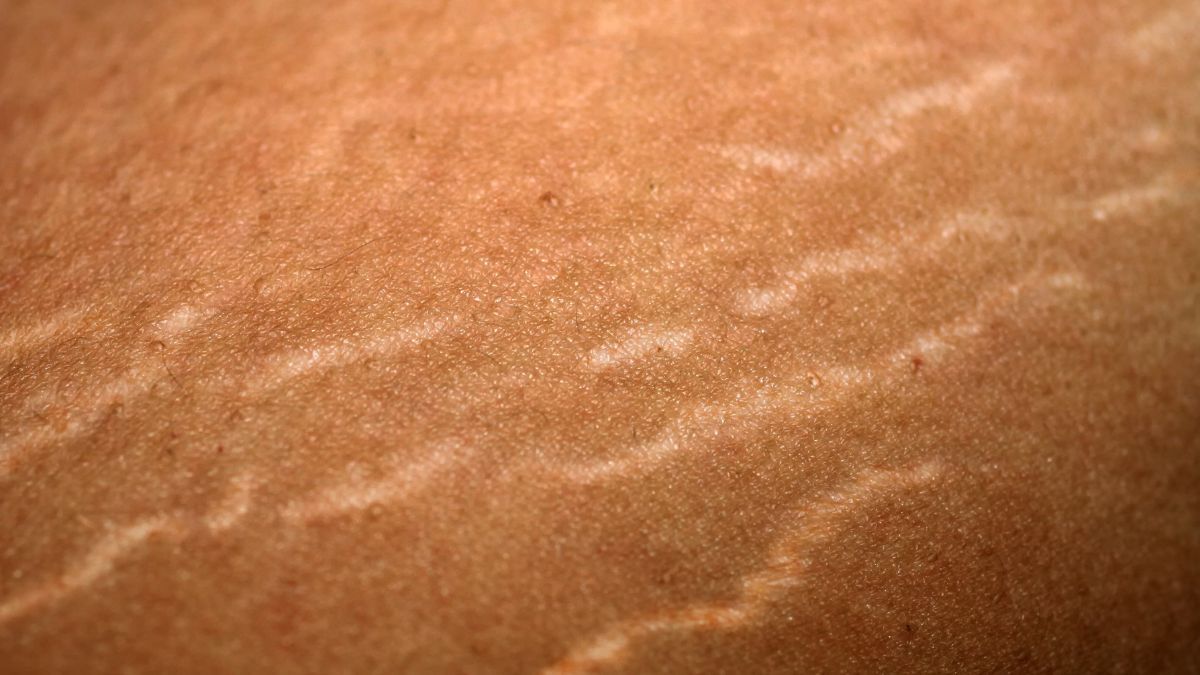 4 Gejala Stretch Mark di Kulit - KlikDokter