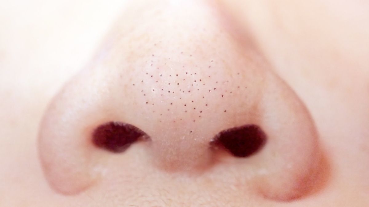 Ada Benjolan di Wajah tapi Bukan Jerawat, Ini Penyebabnya - KlikDokter