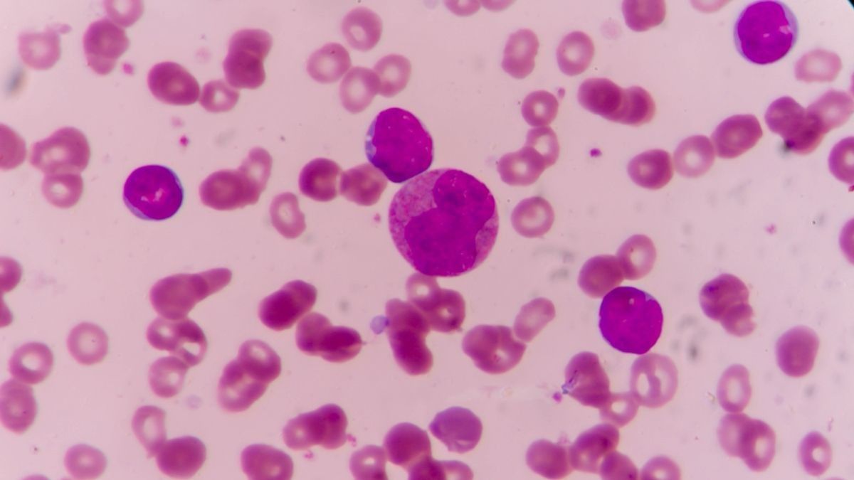 Gejala Trombositopenia yang Mesti Anda Waspadai - KlikDokter