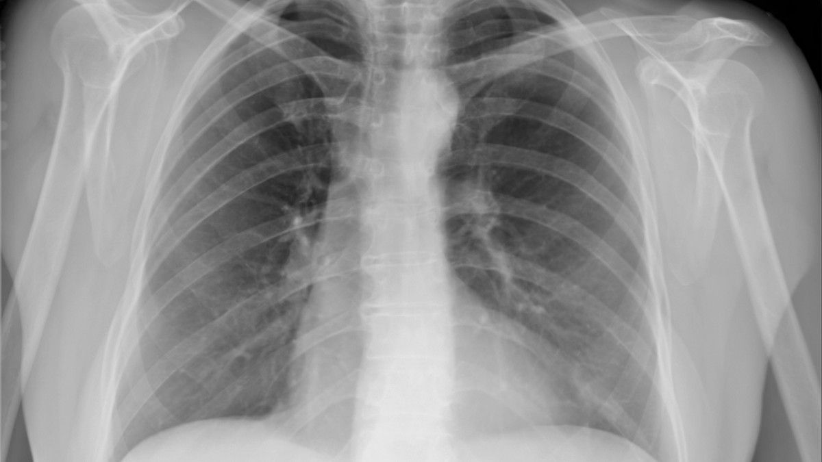 7 Cara Membersihkan Paru-paru Perokok Aktif dan Pasif - KlikDokter