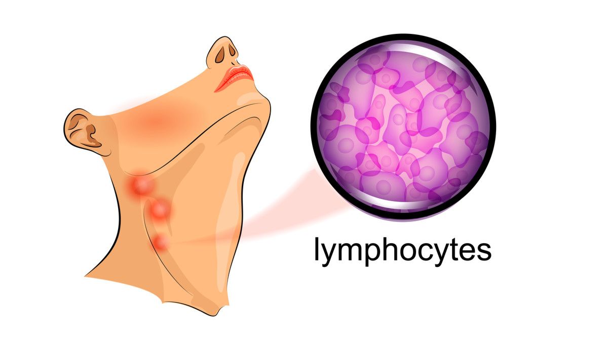 Waspada Limfoma, Ini yang Perlu Kamu Perhatikan - KlikDokter