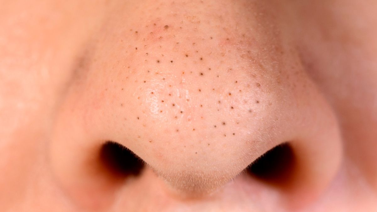 Tips Menggunakan Pore Pack untuk Angkat Komedo - KlikDokter