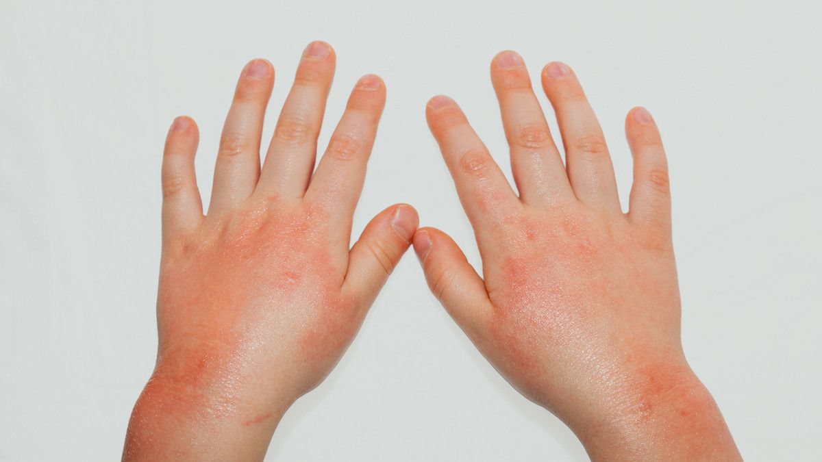 Ruam Kulit - Penyebab, Gejala, Pengobatan - KlikDokter