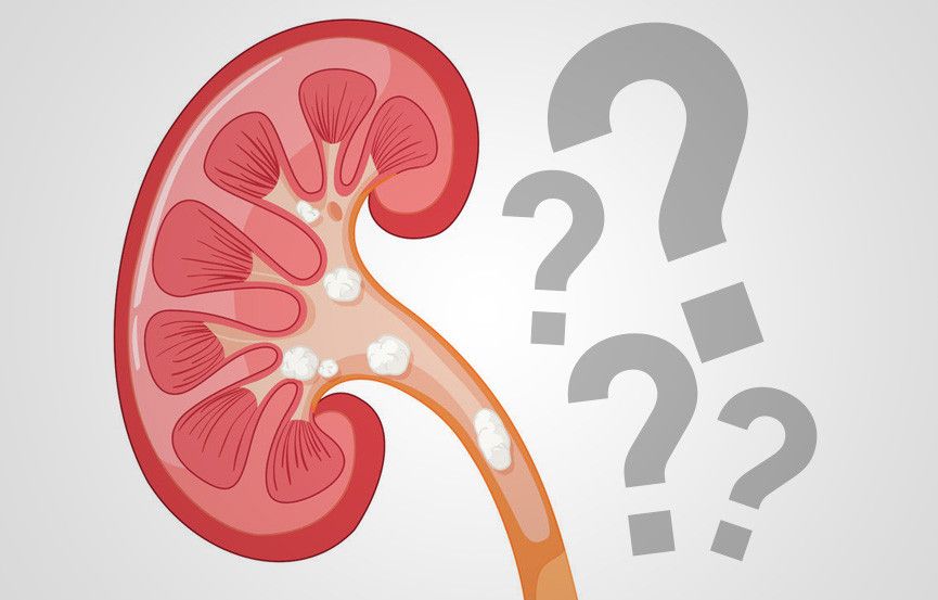Mengungkap Fakta di Balik Batu Ginjal Berulang - KlikDokter