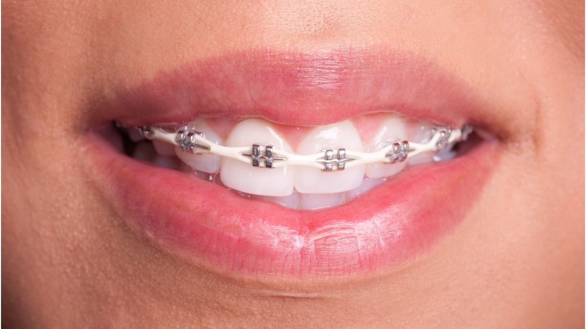 Manfaat dan Risiko Penggunaan Power Chain Braces - KlikDokter
