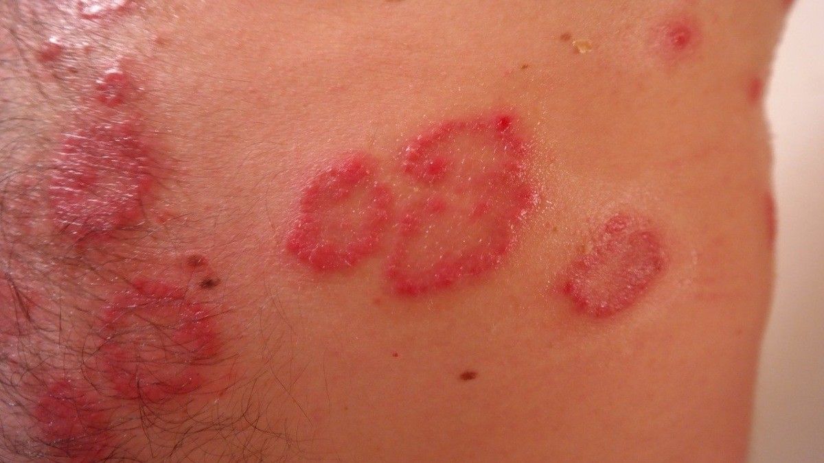 Mana Lebih Mudah Menular, Penyakit Kulit Virus, Bakteri, atau Jamur ...