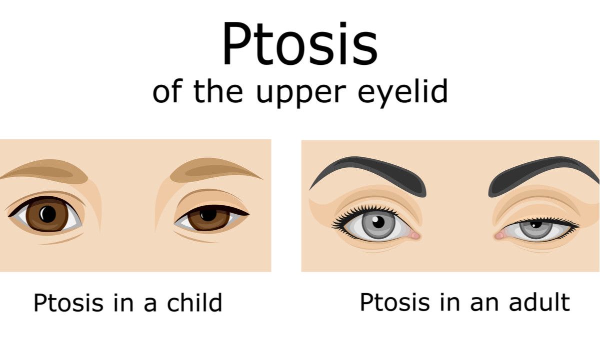 Ptosis, Gangguan Kesehatan Apa Itu? - KlikDokter