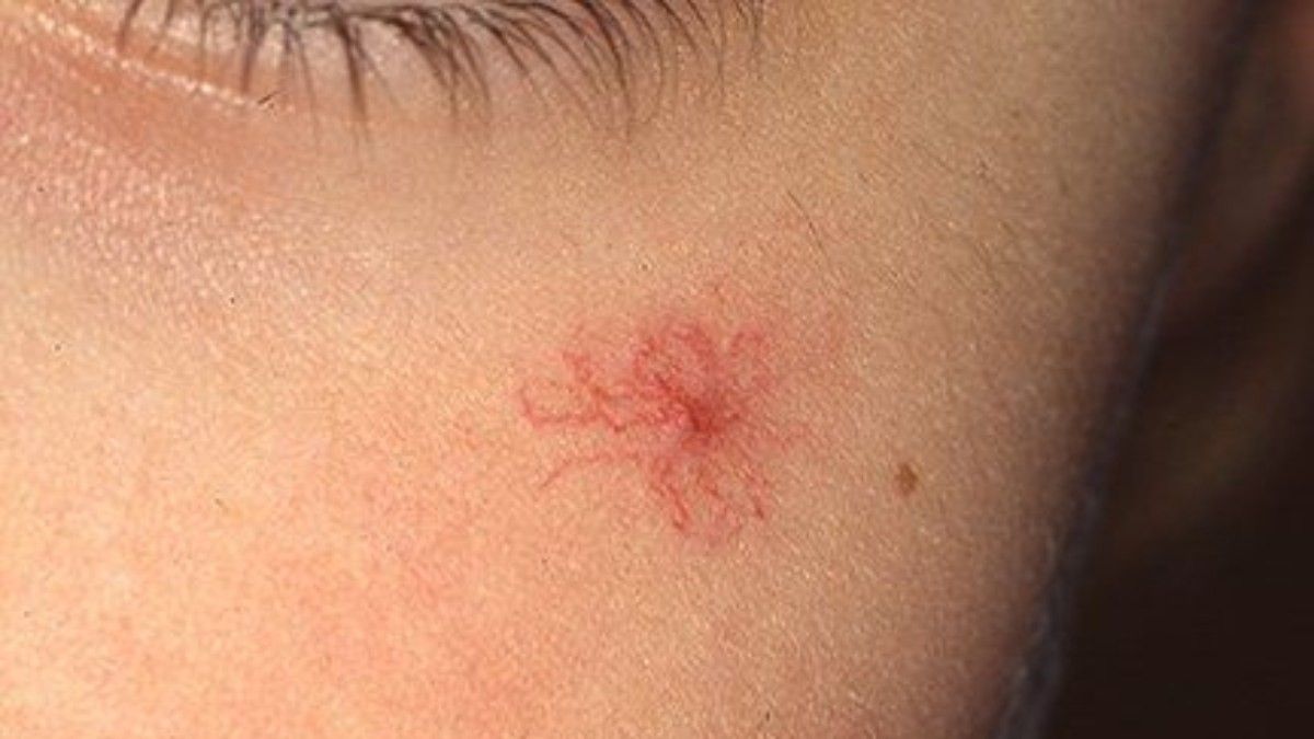 Masalah Kulit yang Biasa Muncul Pasca-Melahirkan - KlikDokter