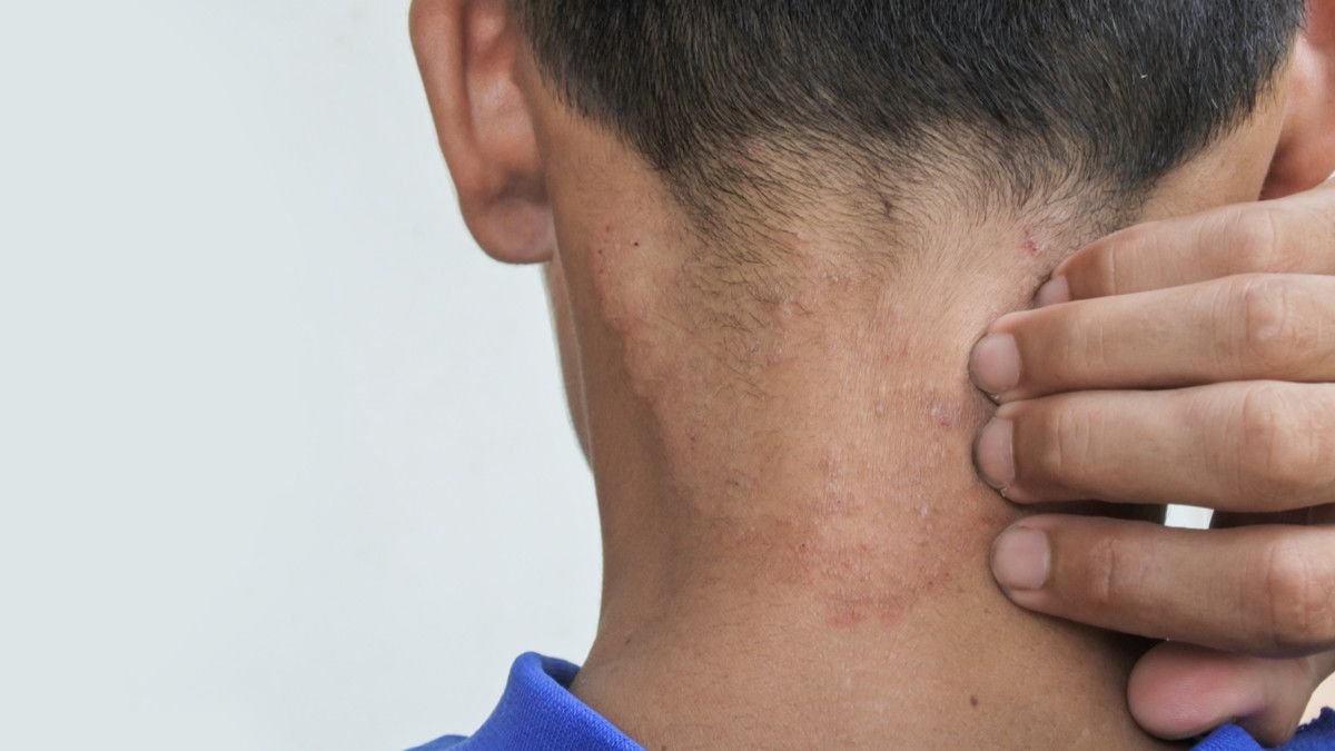 Cara Menghilangkan Kurap di Kulit dengan Bahan Alami - KlikDokter