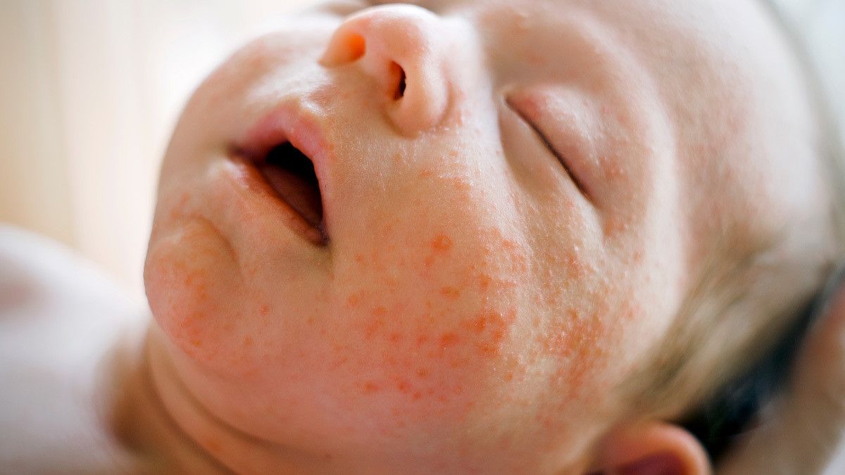 Alergi pada Kulit Bayi yang Perlu Anda Tahu - KlikDokter