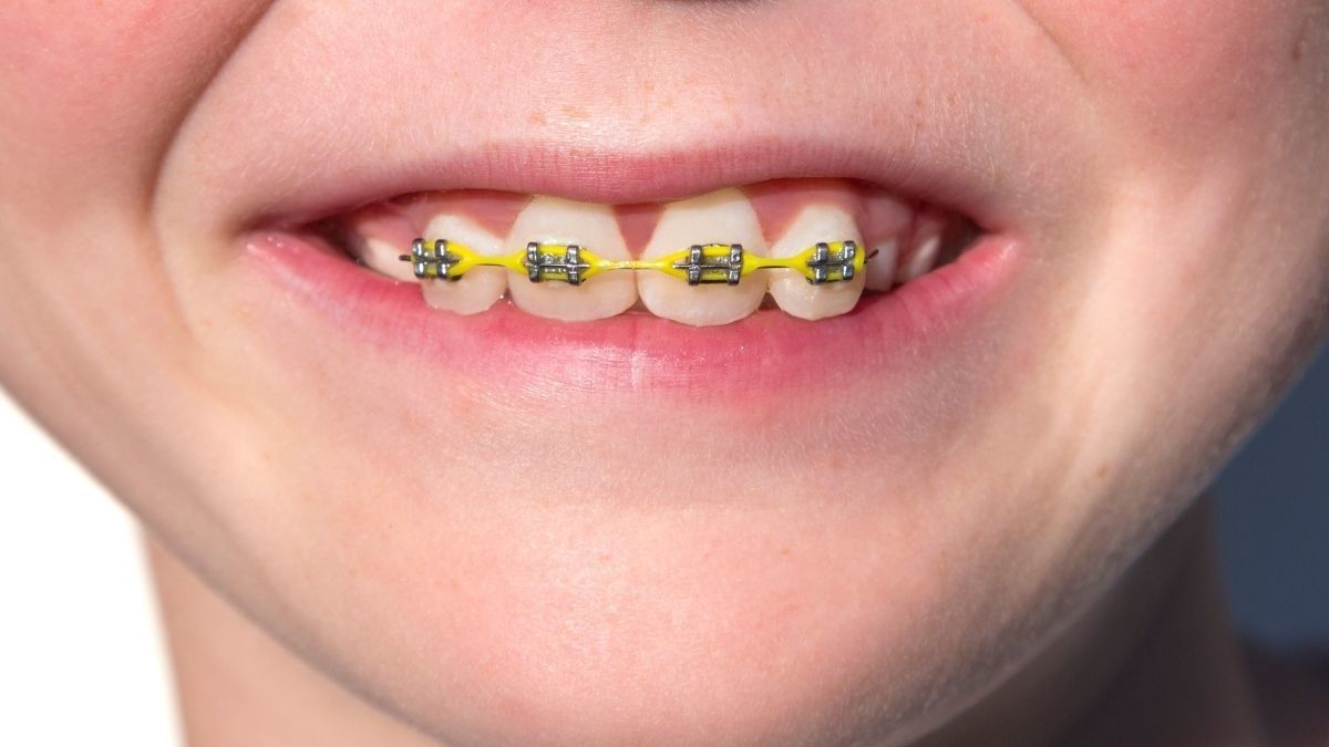 Manfaat dan Risiko Penggunaan Power Chain Braces - KlikDokter