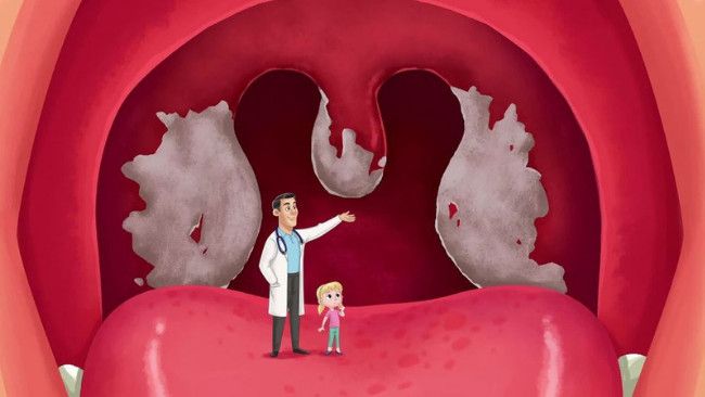 Gejala Awal Difteri yang Jarang Diketahui - KlikDokter