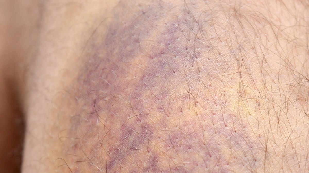 Kulit Berwarna Biru Keunguan, Tanda Penyakit Jantung? - KlikDokter