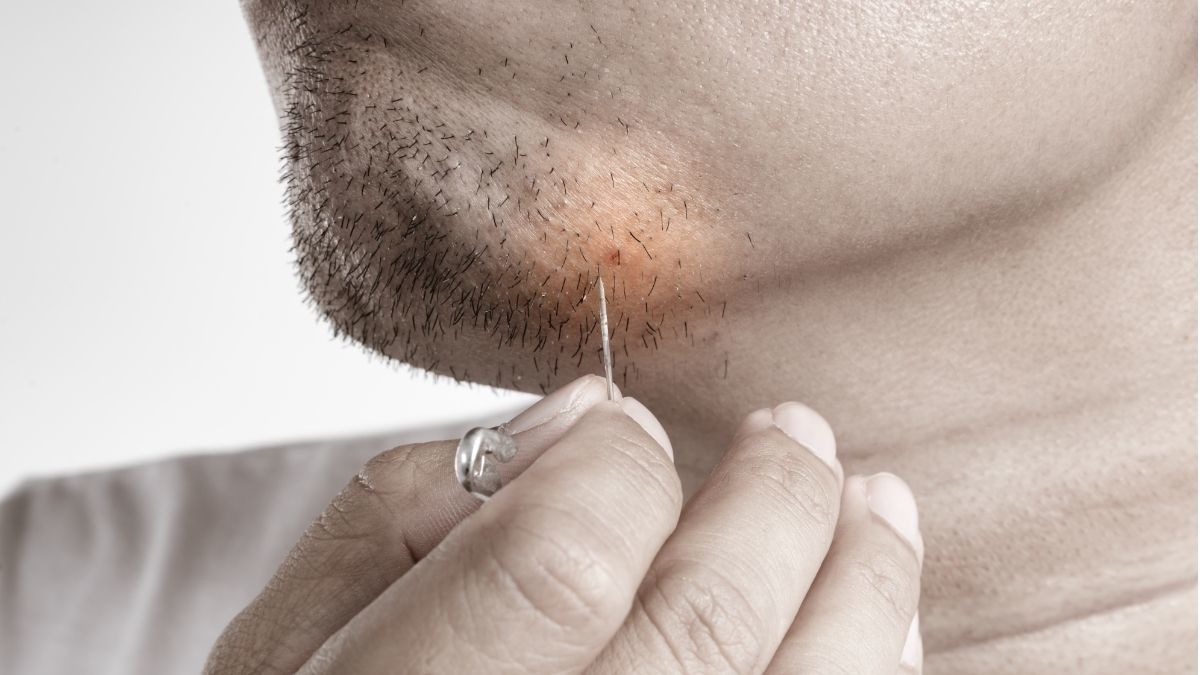 Penyebab dan Cara Mengatasi Ingrown Hair yang Efektif - KlikDokter