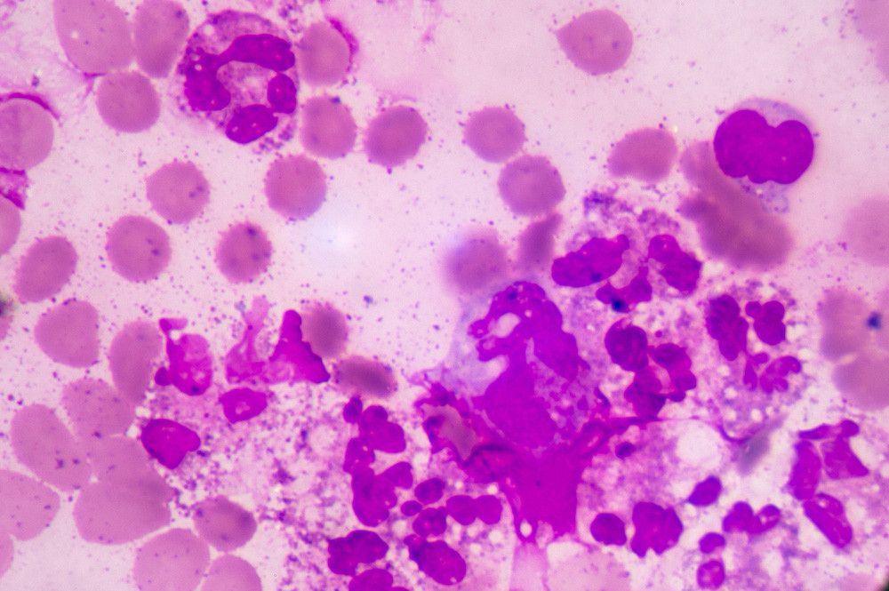 Mengapa Pengidap Pneumonia Berisiko Mengalami Sepsis? - KlikDokter