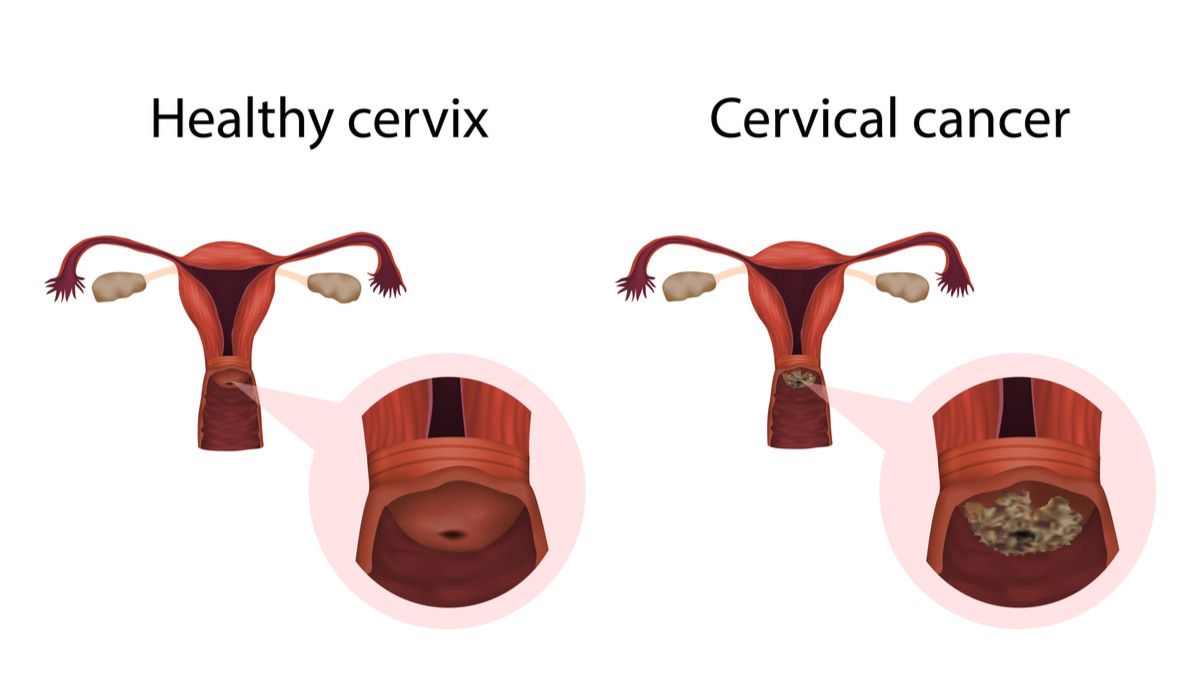 Olahraga untuk Menurunkan Risiko Kanker Leher Rahim - KlikDokter