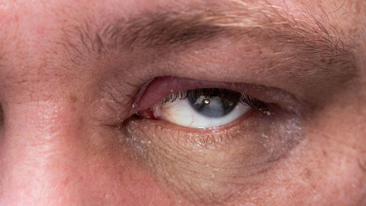 Kenali Gejala Kalazion pada Mata dan Komplikasinya - KlikDokter