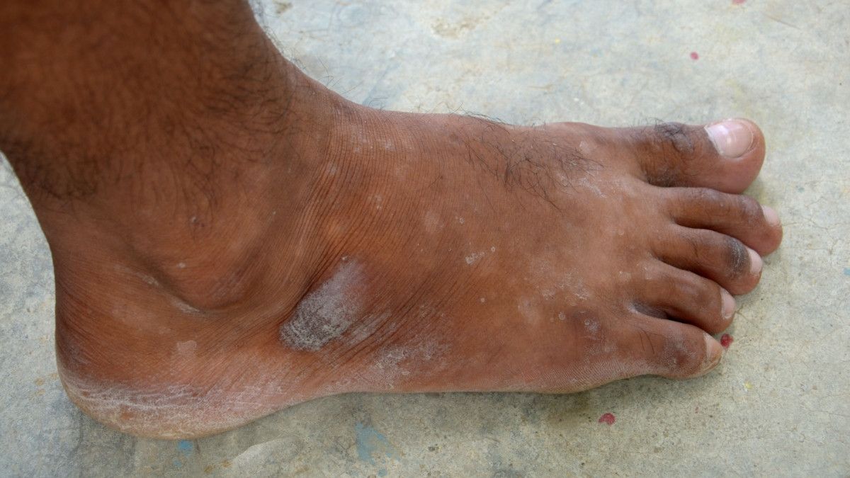 Mycetoma, Penyakit Kulit Kaki Kronis dari Jamur dan Bakteri - KlikDokter