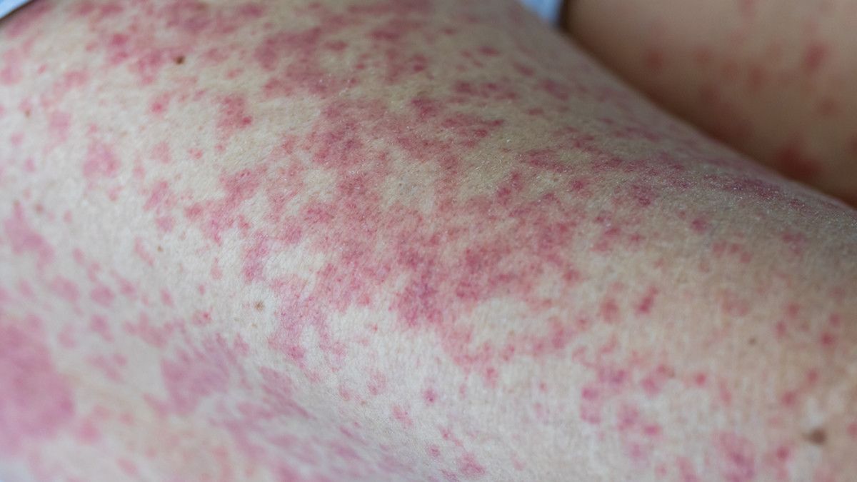 TBC juga Bisa Menyerang Kulit, Kenali Gejalanya! - KlikDokter