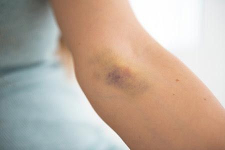 Dari Kedutan Hingga Lebam, Ini Tanda Tubuh Anda Kekurangan Vitamin ...