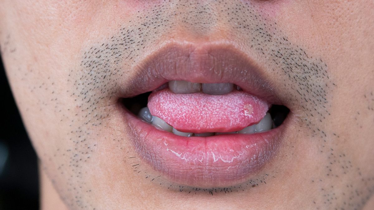 7 Penyebab Papila Lidah Membesar dan Cara Atasinya - KlikDokter