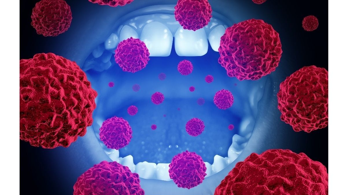 Komplikasi Kanker Mulut yang Perlu Diwaspadai - KlikDokter
