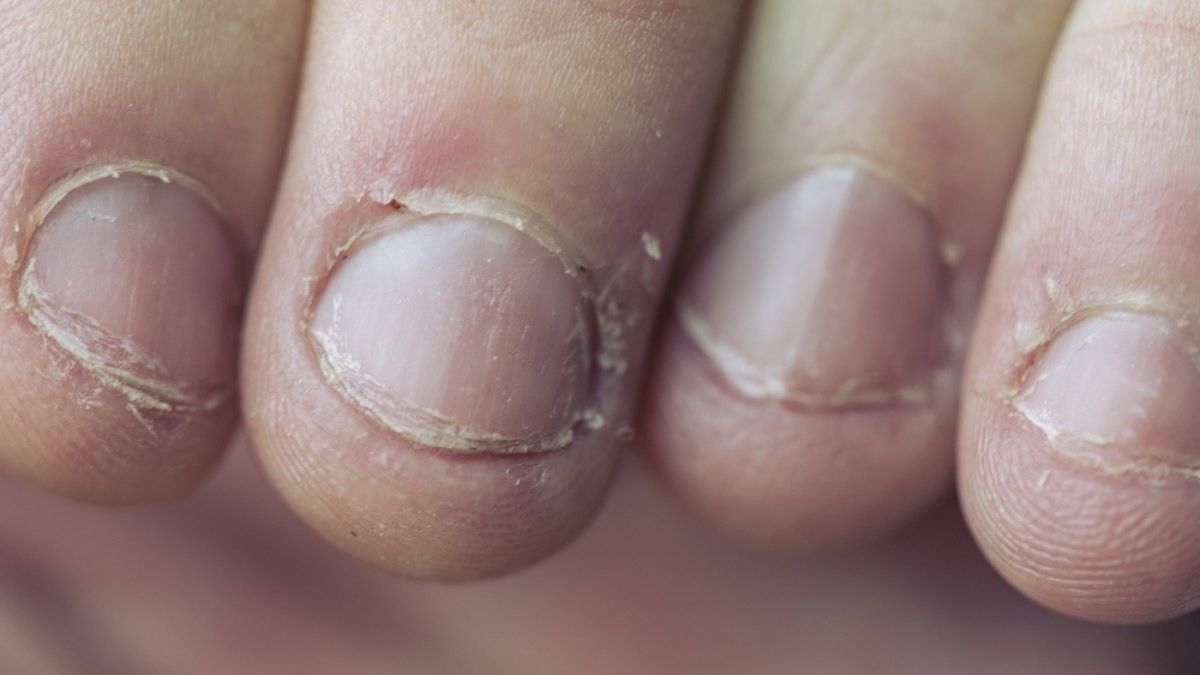 Kuku Pucat, Tanda Penyakit Apa? Ini Kata Dokter - KlikDokter
