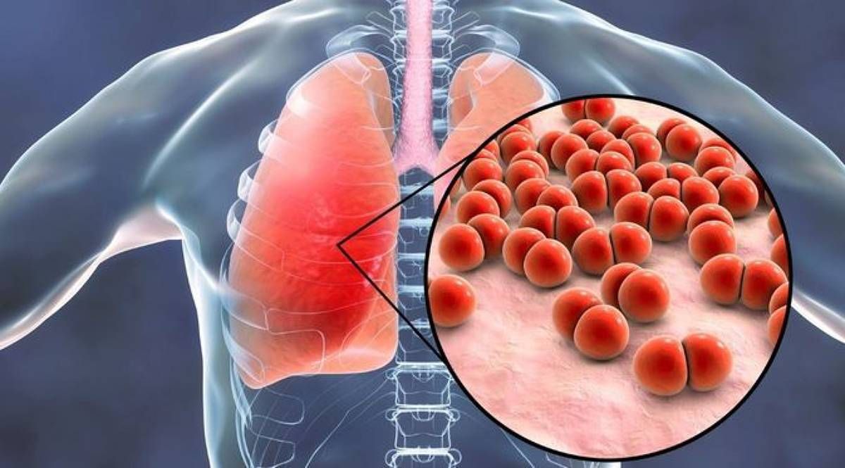Radang Paru-Paru (Pneumonia) - Penyebab, Gejala, Pengobatan - KlikDokter