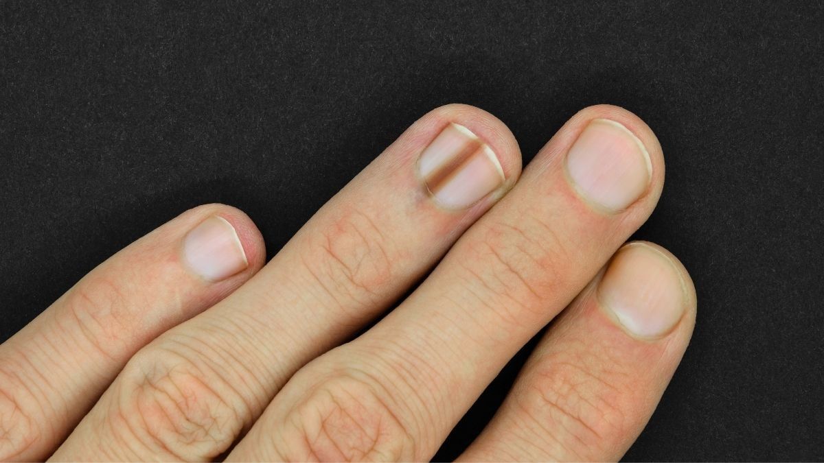 Gejala HIV pada Kuku yang Mesti Anda Kenali dan Waspadai - KlikDokter