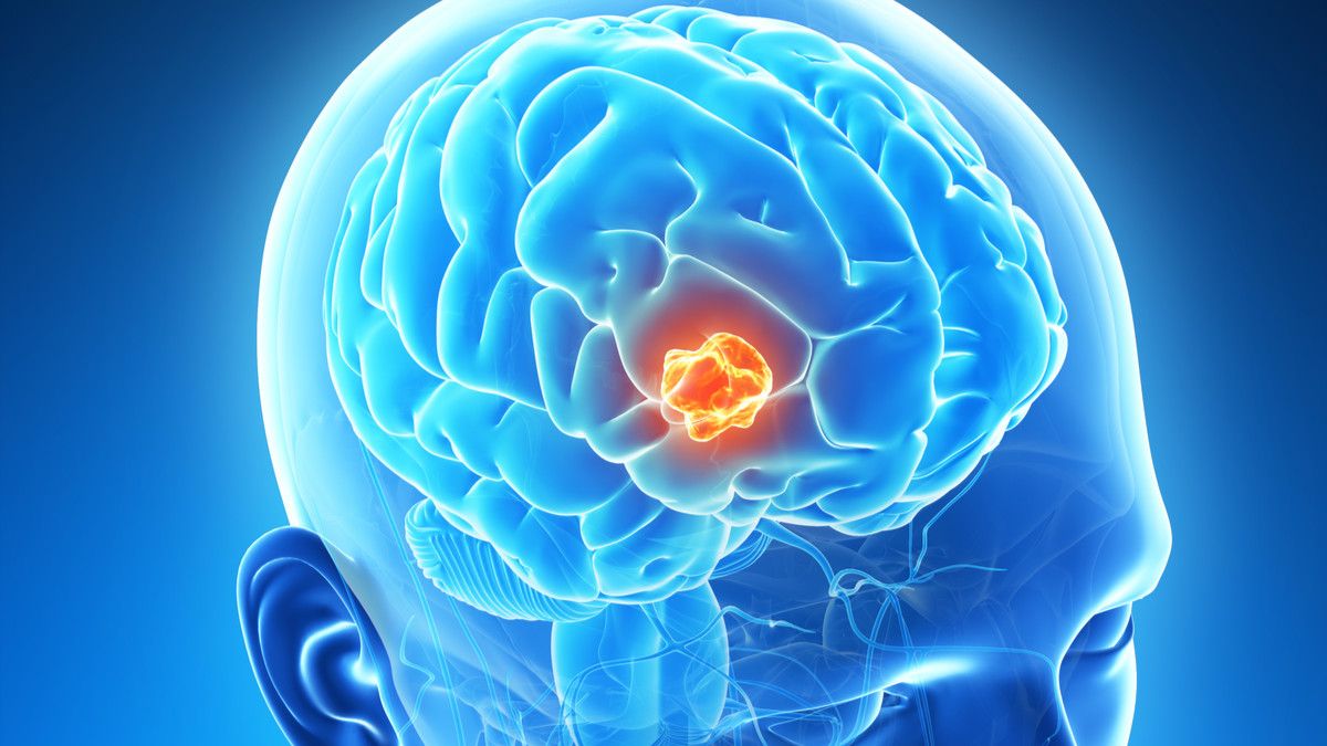 Waspadai 7 Gejala Kanker Otak seperti Dialami Agung Hercules - KlikDokter
