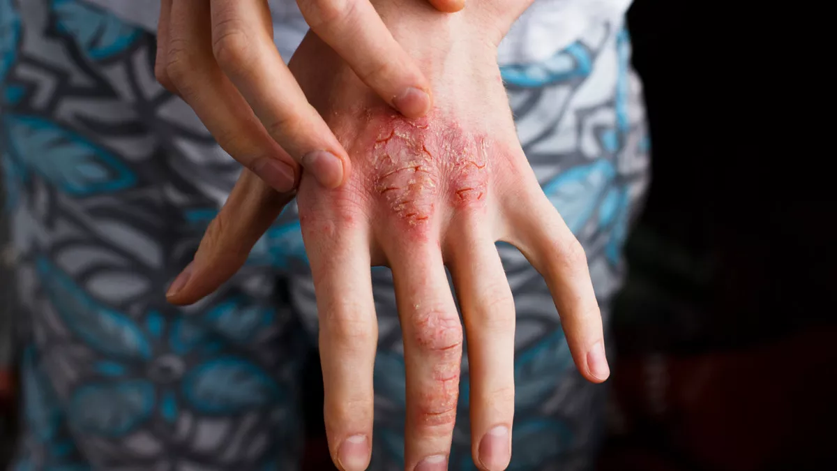8 Pilihan Obat Dermatitis Atopik Sesuai Kondisi Kulit - KlikDokter