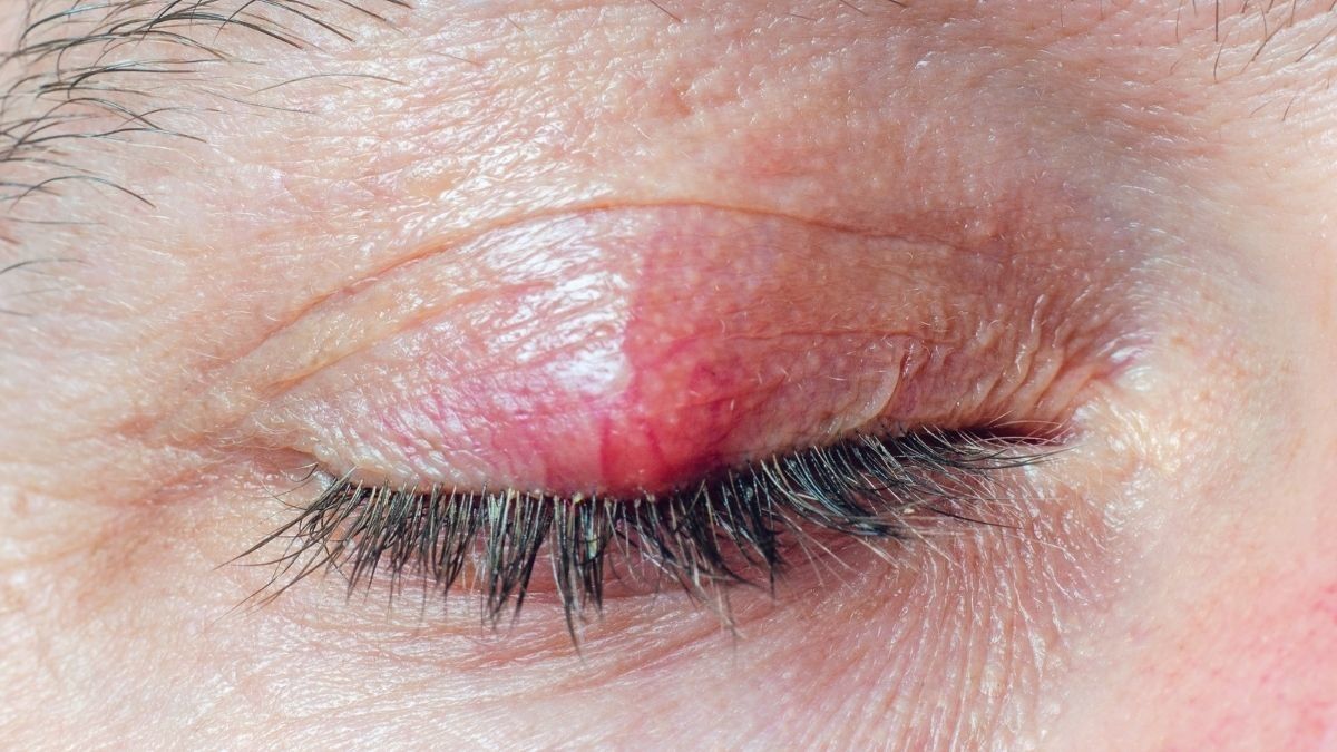 Kenali Gejala Kalazion pada Mata dan Komplikasinya - KlikDokter