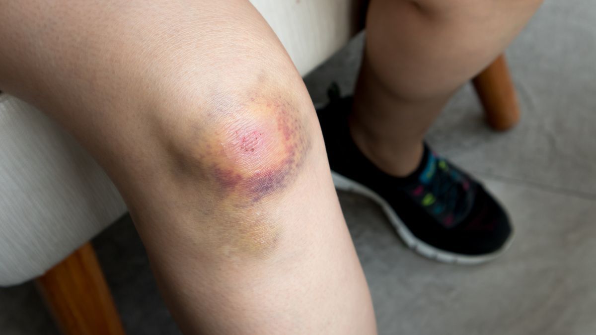 Tubuh Gampang Memar? Ini Penyebab dan Cara Mengatasinya - KlikDokter