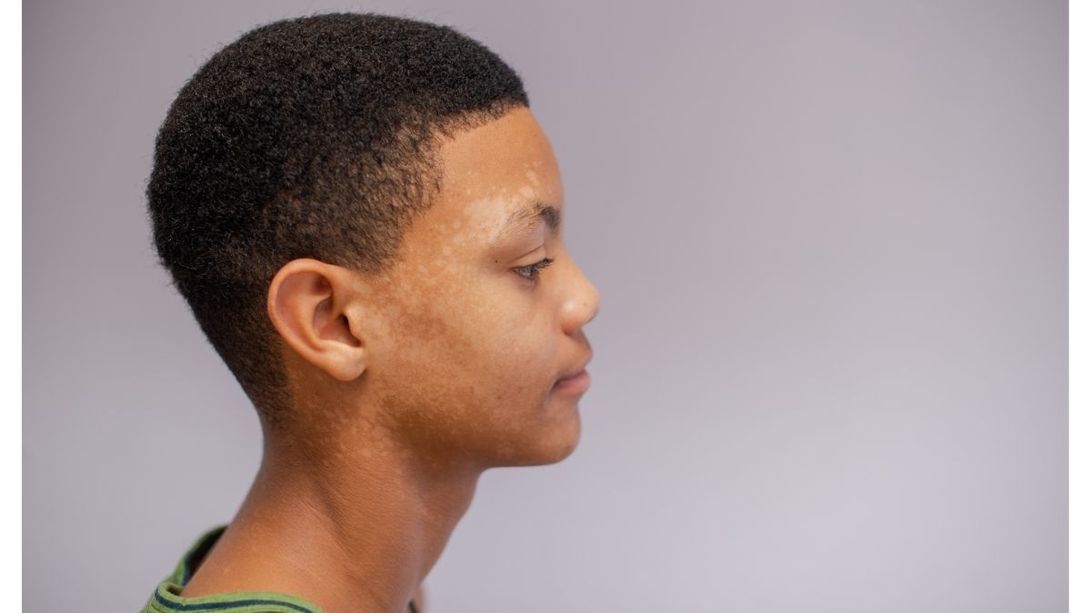 Panu Adalah Penyakit Keturunan, Mitos atau Fakta? - KlikDokter