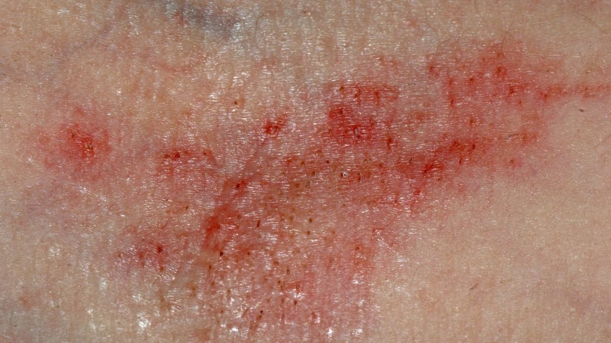 Muncul Ruam saat Demam? Waspada Sindrom Sweet! - KlikDokter