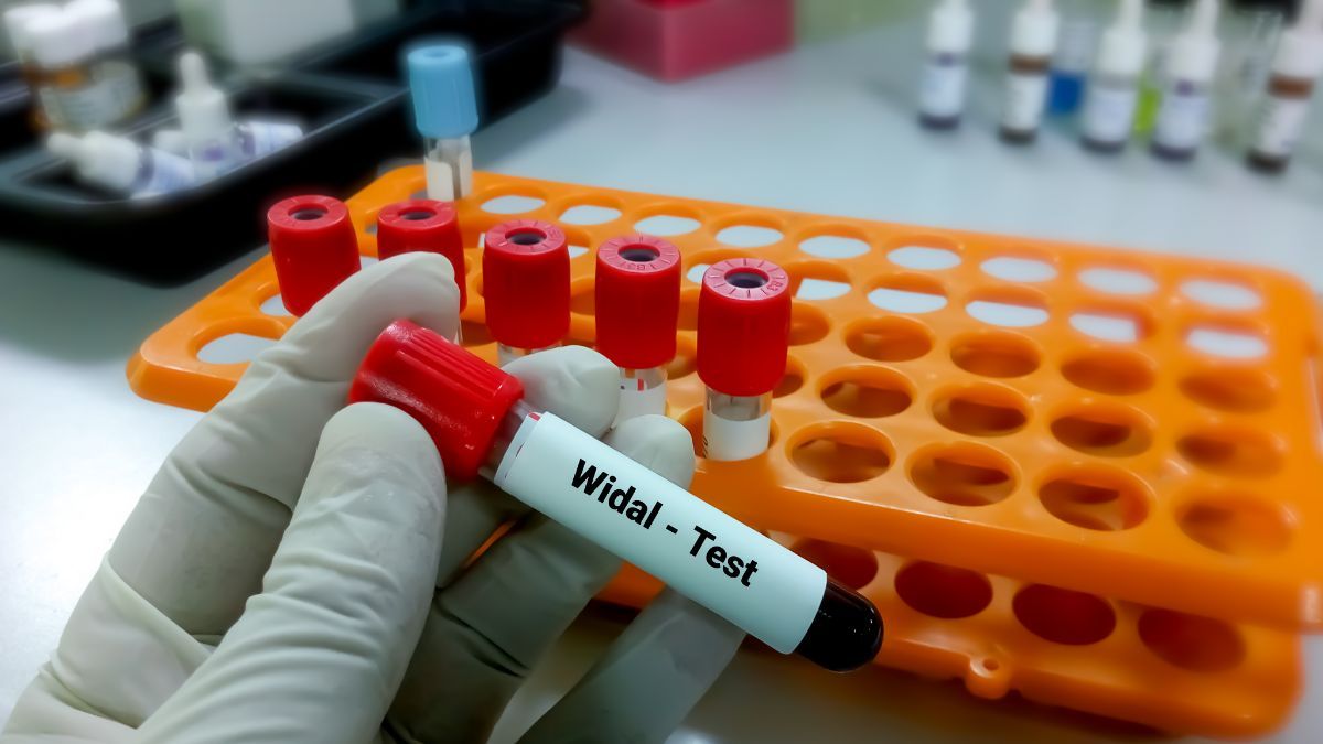 Tes Widal, Pemeriksaan untuk Diagnosis Penyakit Tipes - KlikDokter