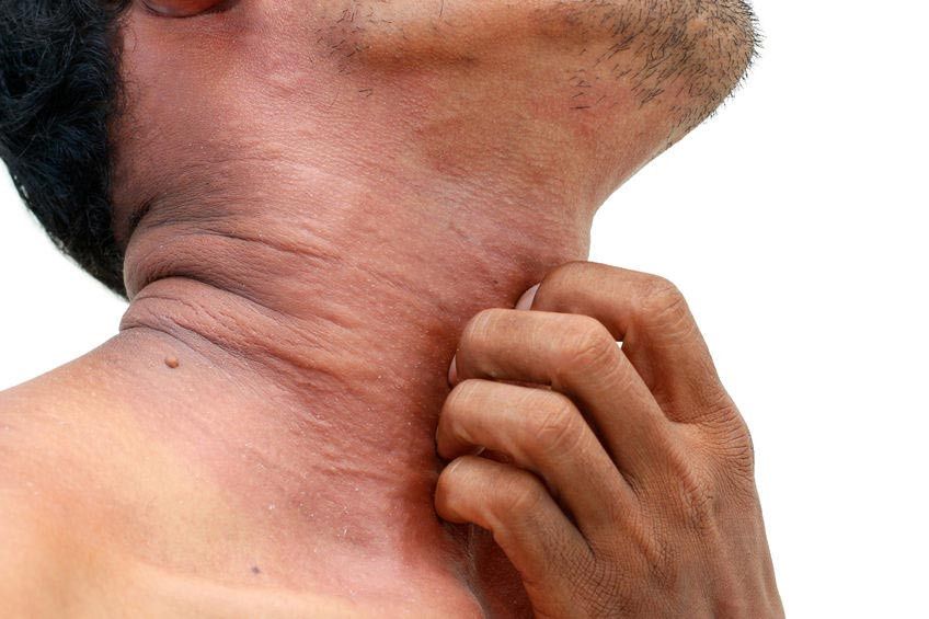 Korengan Akibat Darah Manis, Mitos Atau Fakta? - KlikDokter