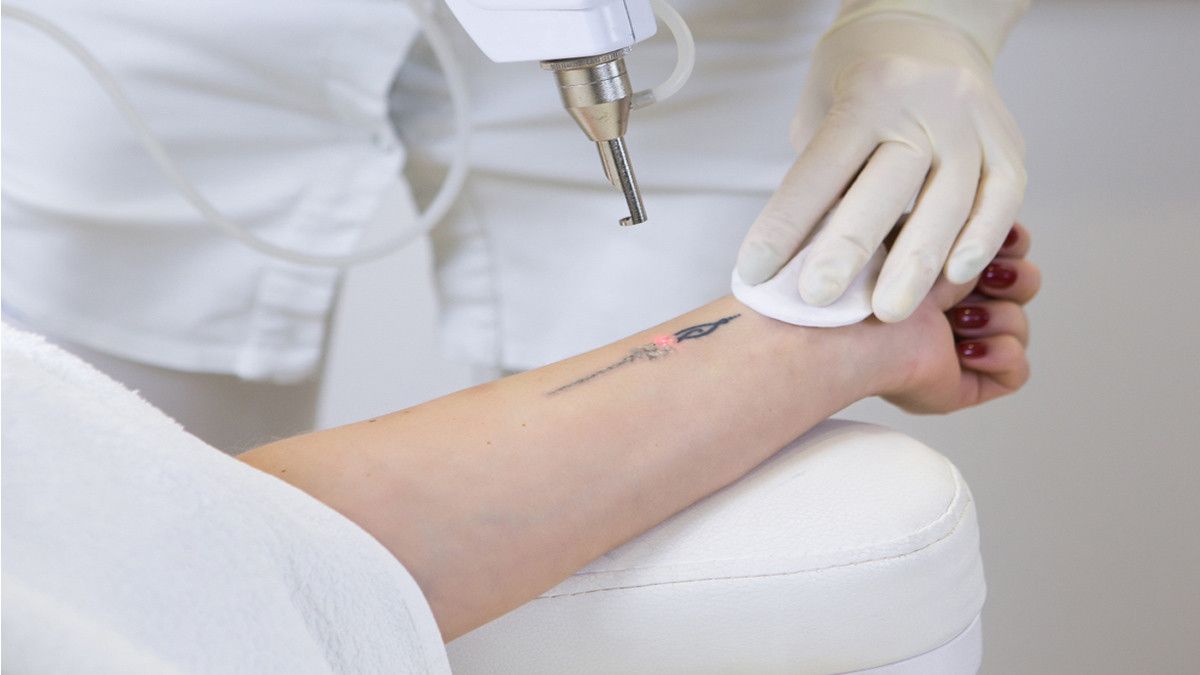 Cara Menghilangkan Tato dengan Laser dan Efek Sampingnya - KlikDokter