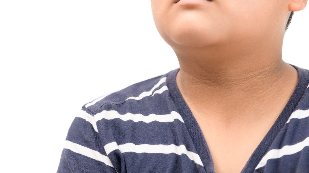 Akantosis Nigrikans, Kelainan Kulit yang Jarang Disadari - KlikDokter