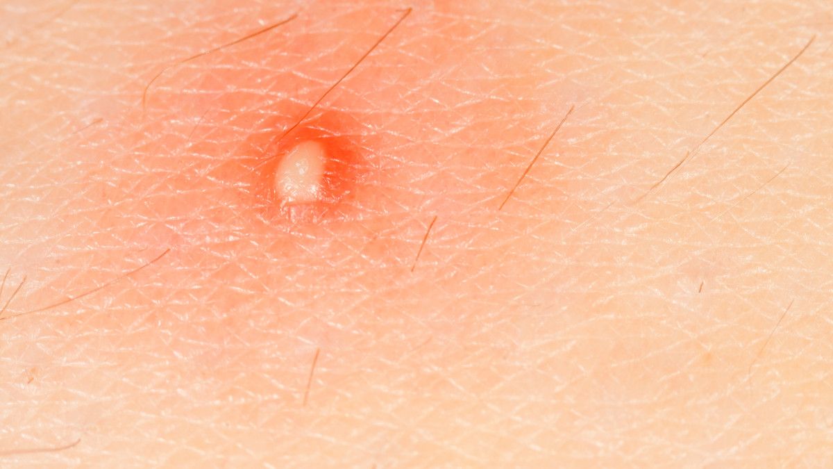 Waspada, Ini Penyebab Bisul pada Penderita Diabetes - KlikDokter